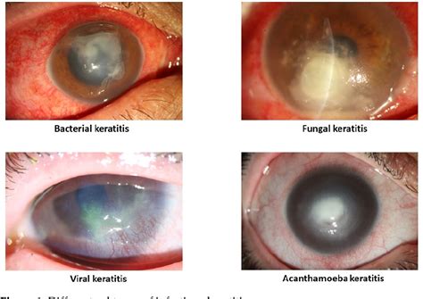 Figure 1 From Artificial Intelligence And Infectious Keratitis Where Are We Now Semantic Scholar