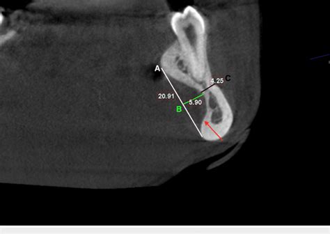 Cross Sectional Cone Beam Computed Tomography Of The Left Lingual Download Scientific Diagram