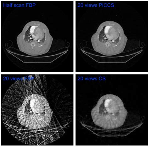 Prior Image Constrained Compressed Sensing Piccs Abstract Europe Pmc