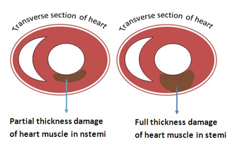 Online Medical Help NSTEMI Vs STEMI