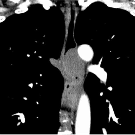 Upper Gastrography And Upper Gastrointestinal Endoscopy A Upper