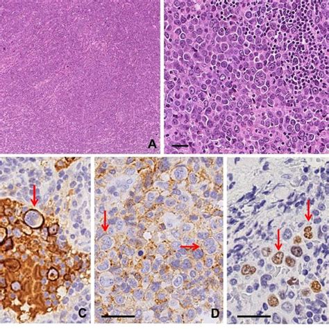Histopathologic Nlphl Variants According To Fan Et Al A Pattern A B Download Scientific