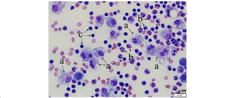 Microscopic Image Of White Blood Cells In Pleural Fluid Wright Giemsa