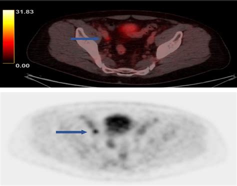 How Image Guided Pathology Can Improve The Detection Of Lymp