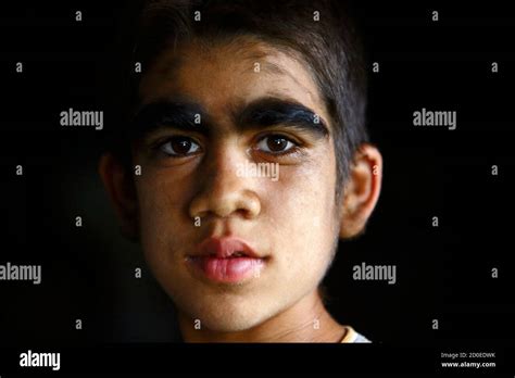 Hypertrichosis Treatment Before And After