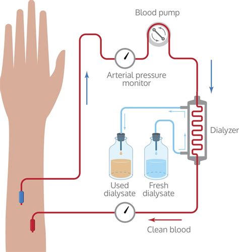 Hemodialysis Diagram Media Portfolio