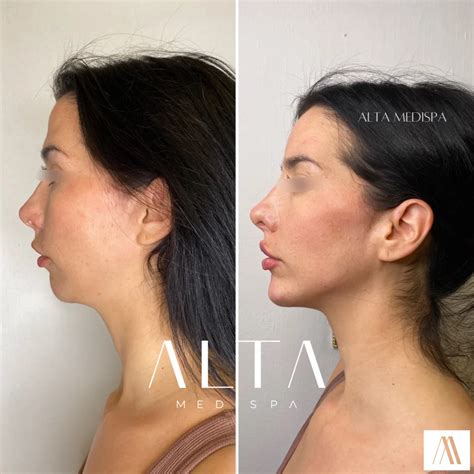 Jawline Filler Before After ALTA MediSpa Results