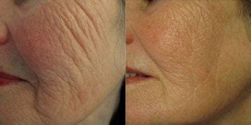Best Way To Shrink Large Pores Laser Treatment Doctor Answers Tips