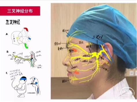 三叉神经解剖及三叉神经痛外科“三驾马车” 脑医汇