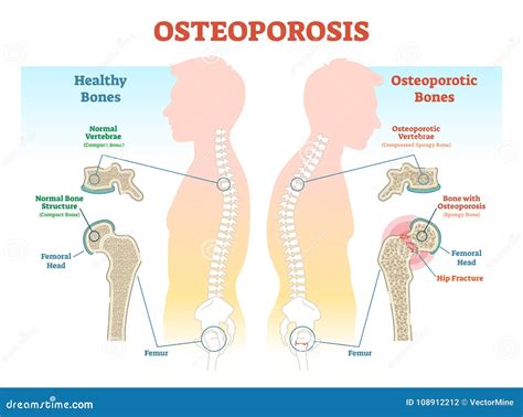 Osteomalacia Diagram