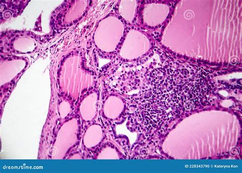 Toxic Diffuse Goiter Or Graves Disease Light Micrograph Stock Photo Image Of Anatomy