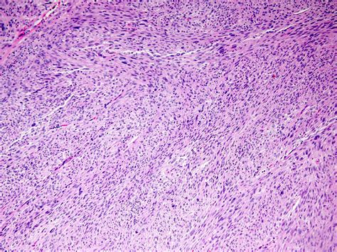 Pathology Outlines Gastrointestinal Stromal Tumor Gist