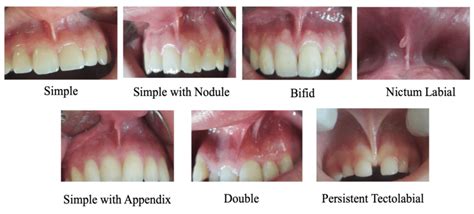 Morphological Type Classificiation According To The Classification Of
