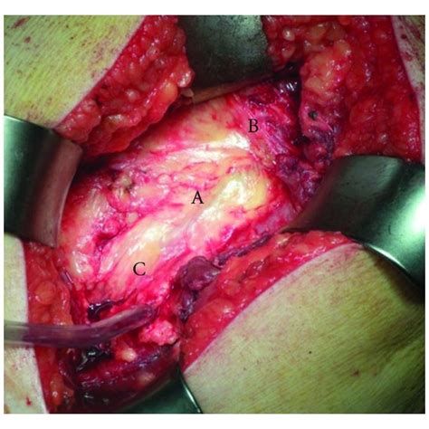 The Sciatic Nerve A Impinging On The Metal Cage B Download Scientific Diagram