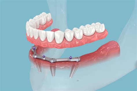 Implant Overdenture Steps And Clinical Protocol
