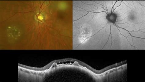 Choroidal Nevus With Lipofuscin