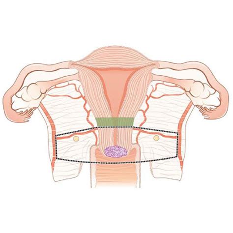 Trachelectomy After Supracervical Hysterectomy A Case Study