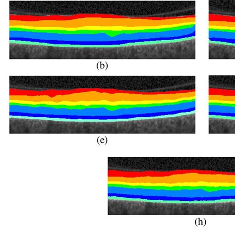 Layer And Fluid Segmentation Results On An Abnormal Oct B Scan Sample Download Scientific