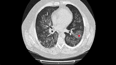Centrilobular Pathology On High Resolution Chest Ct Hrct Youtube