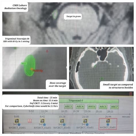 Muhammad Shehwar Khan On Linkedin Trigeminal Neuralgia Srs Treatment 60gy Single Fraction