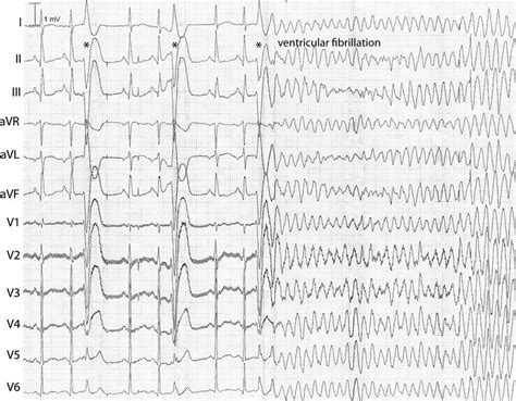 Ventricular Fibrillation Heart And Blood Vessel Disorders Merck