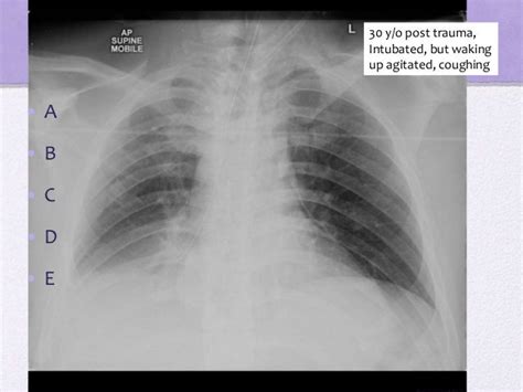 Cxr Interpretation