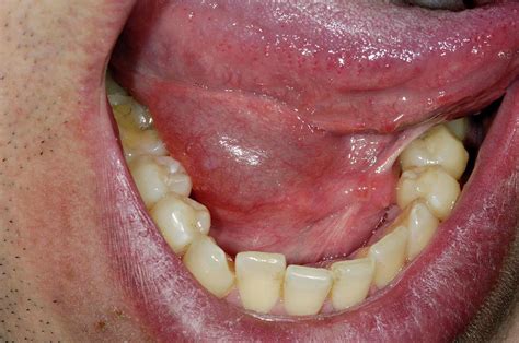 Submandibular Gland Swelling Photograph By Dr P Marazziscience Photo Images And Photos Finder