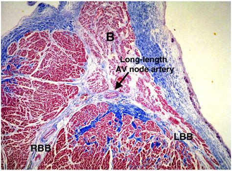 Histological Recognition And Classification Of The Atrioventricular