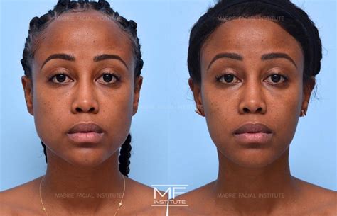 How To Get Definedhigh Cheekbones With Cheek Filler In San Francisco