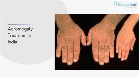 Acromegaly Treatment Symptoms Causes Diagnosis