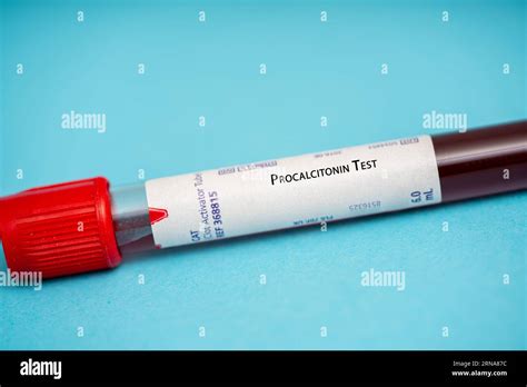 Procalcitonin Test This Test Measures The Levels Of Procalcitonin A Protein Produced By The