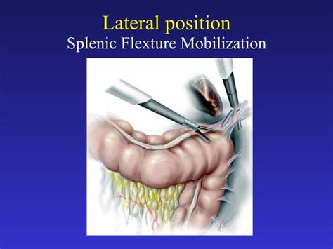 Laparoscopic Sigmoid Colon Resection For Diverticular Disease Ppt