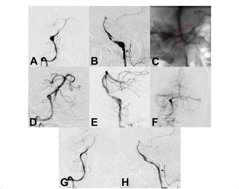 A B Preoperative Angiography Showed An Unruptured Vertebral Artery Download Scientific Diagram