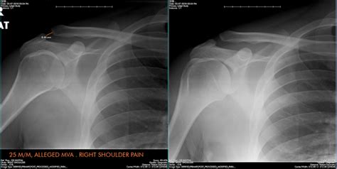 Acj Injuries Collection Of Plain X Rays