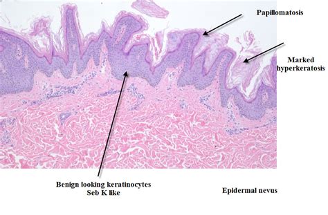 Epidermal Nevus Histology Linear Verrucous Epidermal Nevus
