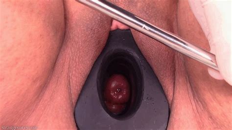 Cervix Stretching With Hegar Dilators Strangecares