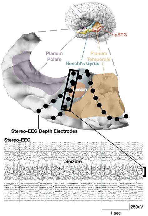 Superior Temporal Plane Reconstruction Of The Suspected Seizure Focus Download Scientific