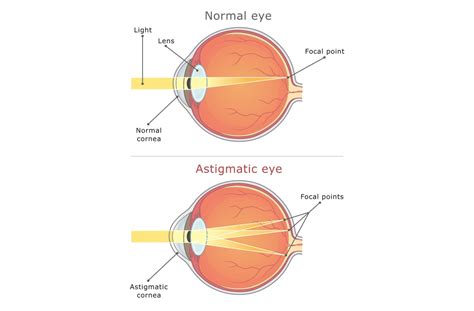What Causes Astigmatism To Worsen
