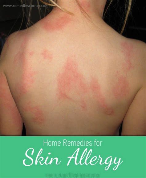 Chocolate Allergy Rash Treatment At Harry Oloughlin Blog