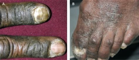 Bazex Syndrome