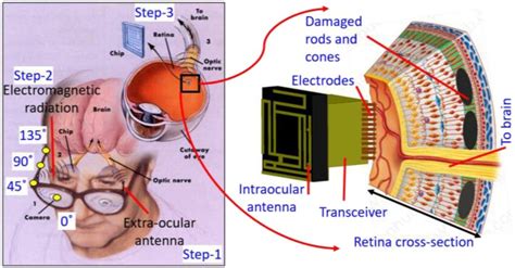 Retinal Prosthesis Scenario Edited Original Image From Second Sight