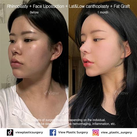 😍 ️😮хамрын хагалгаа нүүрний өөх View ГОО Сайхны Эмнэлэг