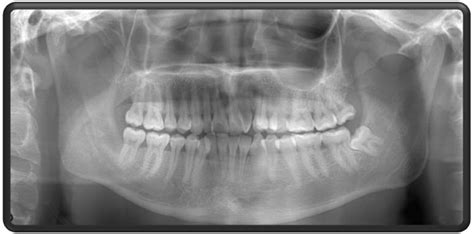The Extraction Socket Of The Upper Right Third Molar Can Be Detected On