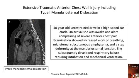 Sternal Fractures And Dislocations Emguidewire Radiology Reading Room