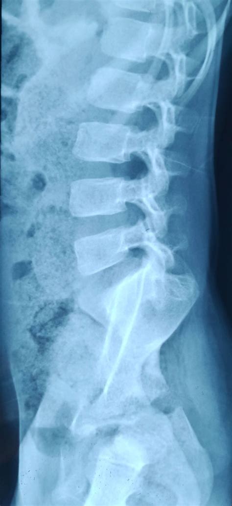 Muhammad Bilal On Linkedin 12 Years Male Caudal Regression Syndrome Sacral Agenesis Double…