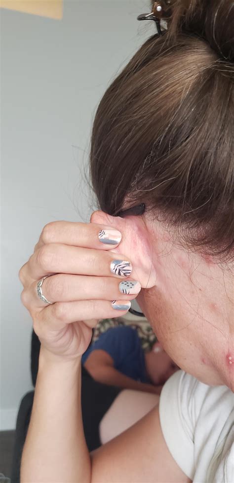 Should I Be Concerned About Shingles On My Ear Rshingles