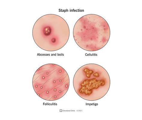Methicillin Resistant Staphylococcus Aureus Mrsa Dan Kesihatan Ukm Medical Molecular Biology