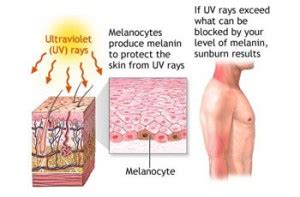 Sunburn Skin Cancer And Aging Of The Skin