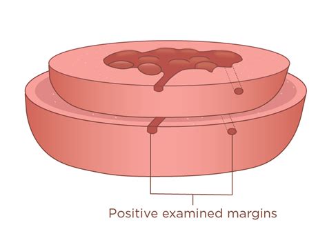 Mohs Surgery Vs Wide Excision What Are The Differences Bangkok Hospital Phuket