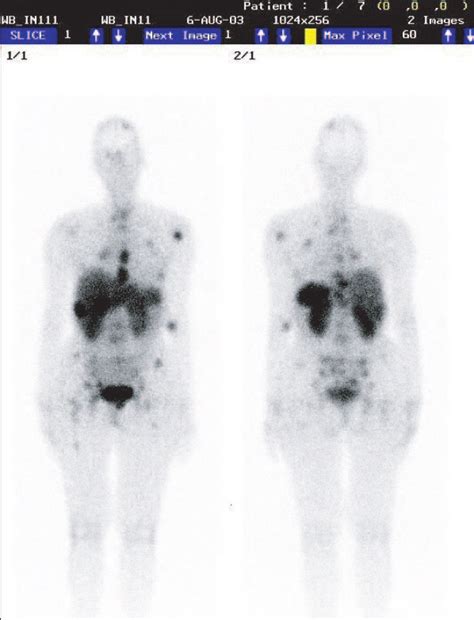 Whole Body 111 Indium Pentetreotide Scan Showing Multiple Metastatic